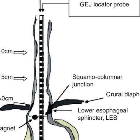 Pdf Measuring Movement And Location Of The Gastroesophageal Junction