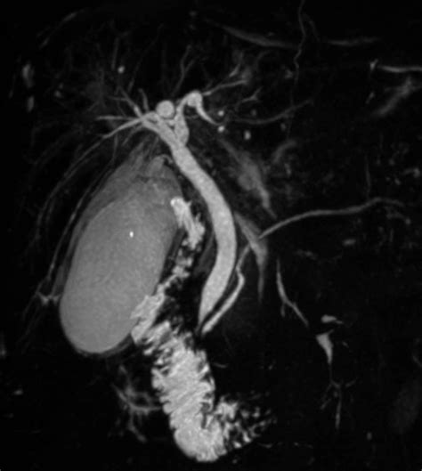 Mrcp Image A Non Invasive Approach To Hepatobiliary Radiology Vashil