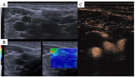 The Diagnostic Performance Of Multiparametric Ultrasound In The
