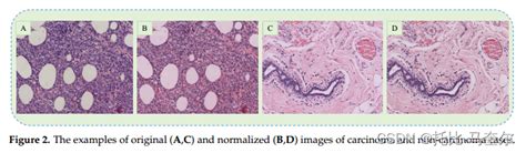 使用深度学习集成模型进行乳腺癌组织病理学图像分类深度学习病理图像处理 Csdn博客