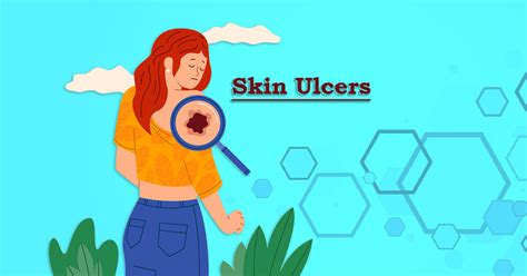 Skin Ulcers Causes Symptoms Effective Treatments
