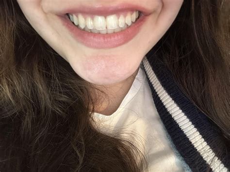 Got My Braces Off Today Thoughts Rbraces