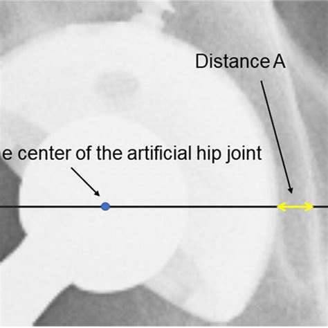 The Distance From The Medial Margin Of The Acetabular Cup To The