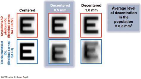 Crystalens Trulign Intraocular Lenses Ento Key