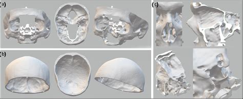 Computational Model Of The Skull Segmented From The Cbct Image The