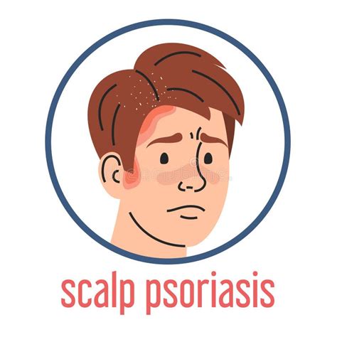 Scalp Psoriasis Stock Illustrations Scalp Psoriasis Stock Illustrations Vectors Clipart