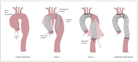 Importance Of Stent Graft Design For Aortic Arch Aneurysm Repair