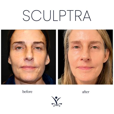 Before And After Sculptra Sculptra Sculptra Aesthetic Facial Fillers