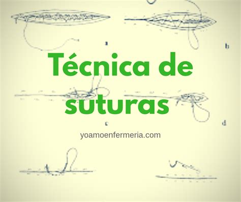 Técnicas De Suturas