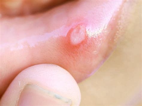 What Causes Chronic Canker Sores On Tongue
