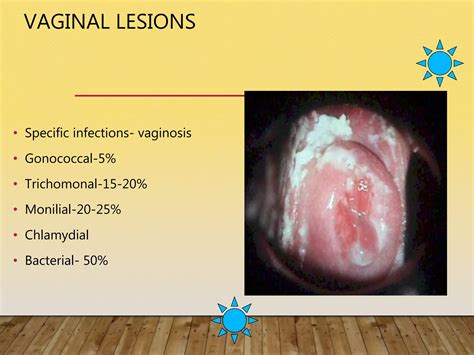 Linear Vulvar Lesions Fissures Herpes Simplex Virus And Drug