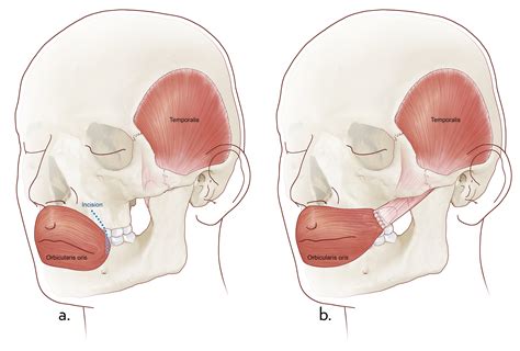 Facial Tendons