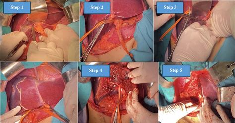 Right Anatomical Hepatectomy Using Extrahepatic Glissonean P