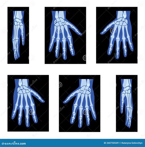 Set Of X Ray Hands Skeleton Human Body Bones Adult People Roentgen