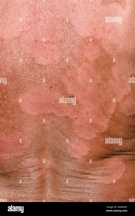 Ringworm Rash Close Up Of A Rash On The Back Of A 59 Year Old Male