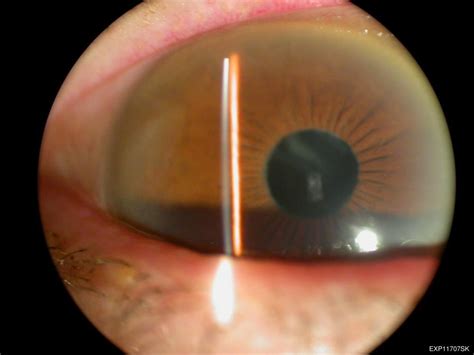 Ppt Ex Press® Device In Clinical Practice New York September 2011 Powerpoint Presentation