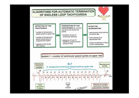 Pacemaker Mediated Tachycardia Or Not Pdf