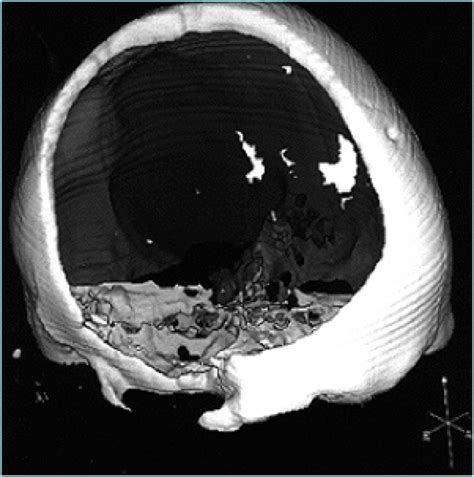 Three Dimensional Ct Reconstruction Showing An Optimal Decompression Download Scientific