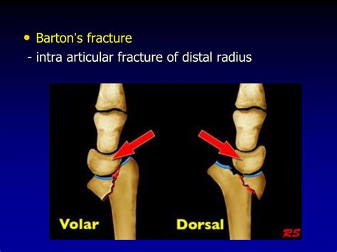 Ppt Recognizing Fractures Powerpoint Presentation Free Download Id