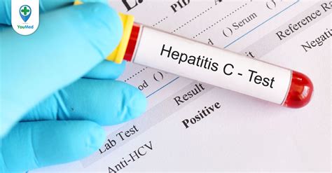 Các Xét Nghiệm Chẩn đoán Viêm Gan C Bao Gồm Những Gì Cần Lưu ý Gì Khi