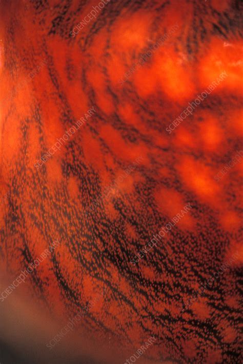 Colpitis Caused By Trichomonas Vaginalis Colposcopy Stock Image