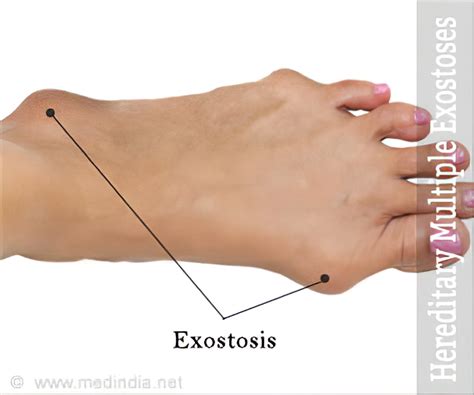 Multiple Hereditary Exostoses Mhe