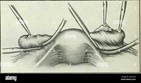 A Manual Of Gyn Cology And Pelvic Surgery For Students And Practitioners Result Of