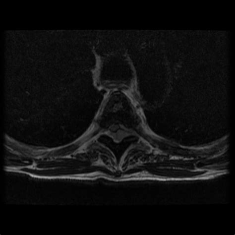 Radiopaedia Case Severe Spinal Cord Compression From Epidural Prostate