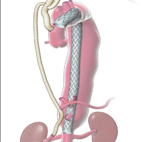 Dacron Graft Repair Of Ascending And Descending Aortic Dissection