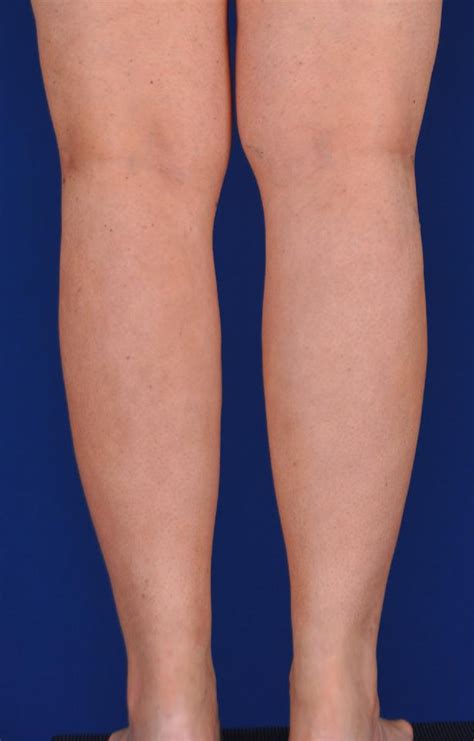 Calf And Ankle Liposuction Phoenix Liposuction