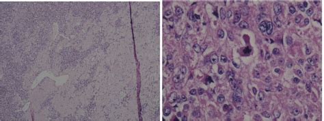 Microscopic Features Of The Sclerosing Stromal Tumor A Pseudolobular