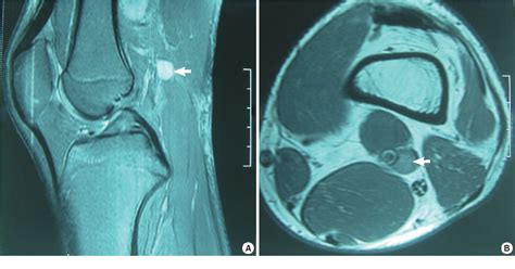 Popliteal Lymph Nodes Mri