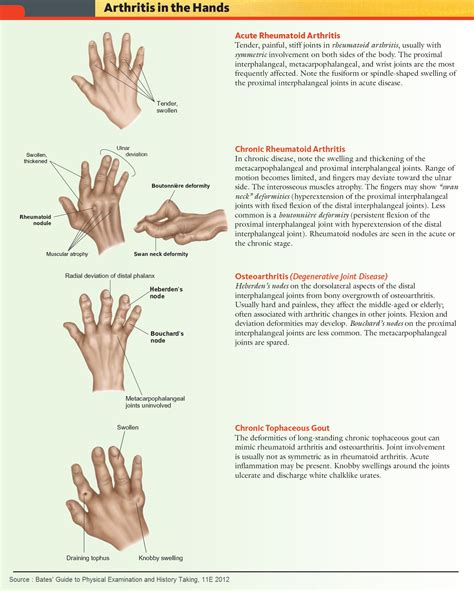 Different Types Of Arthritis