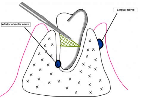 What Is Dental Coronectomy At Erna Davila Blog