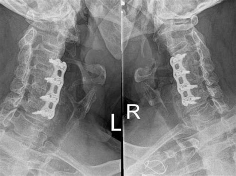 Pseudarthrosis Cervical Spine Ppt