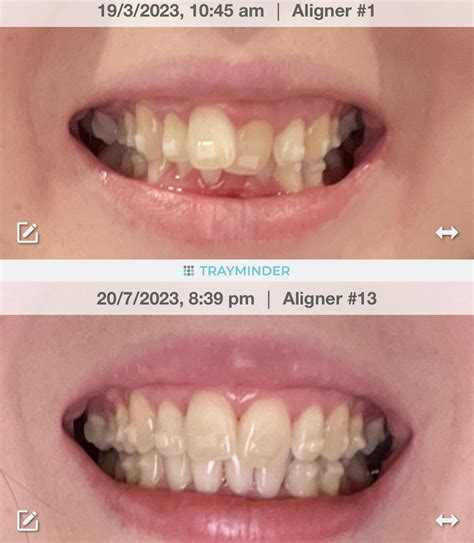 Tray 1319 Progress Developing Black Triangles But Happy With The