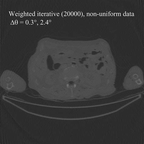 weighted iterative landweber reconstruction of a patient torso slice