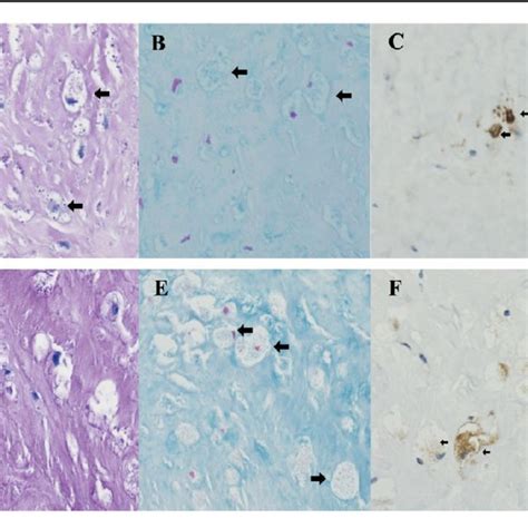 Photomicrographs Of Ab Aortic Valve Tissue And De Mitral Valve
