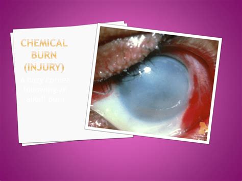 Ppt Acute Red Eye And Ocular Pain Powerpoint Presentation Free