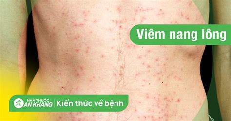 Bệnh Viêm Nang Lông Hiểu Rõ Vấn đề Và Cách điều Trị Hiệu Quả
