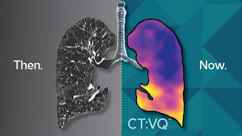 Ct Vq™ 4dmedical