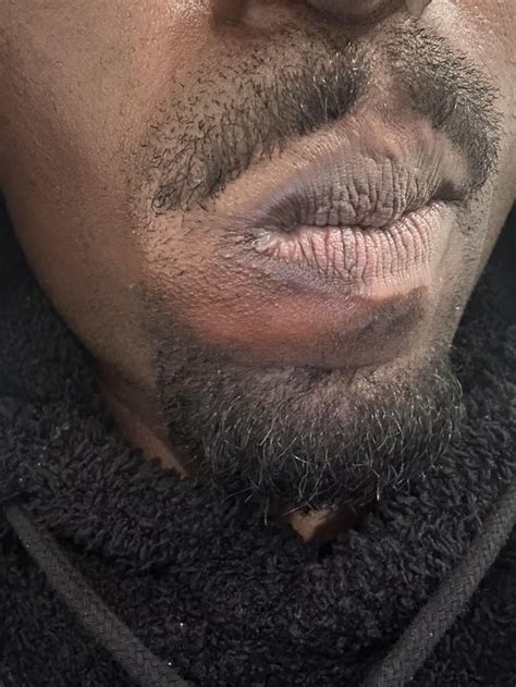 Is She Still Giving Angular Cheilitis R Skincareaddicts