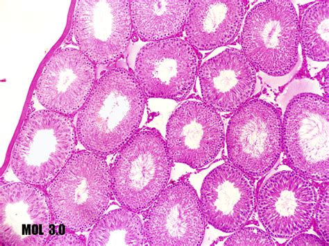Histologia Testicular Rotulada Tumor Testicular Bilateral Sincrónico