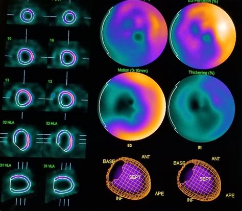 Nuclear Stress Test Advanced Cardiac Care Pllc