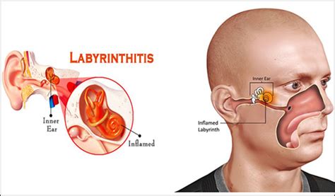 Natural Cure For Labyrinthitis With Herbal Remedies
