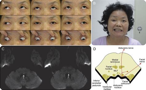Teaching Video Neuroimages Palsy Of Conjugate Horizontal Gaze And Face