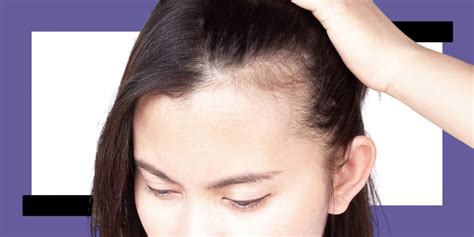 Female Baldness And Hair Loss Causes And Solutions