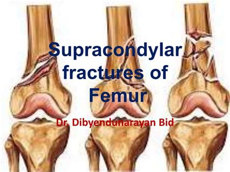 Femur Supracondylar Fractures Ppt