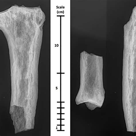 Radiographs Of Proximal And Distal Fragments Of The Left Tibia
