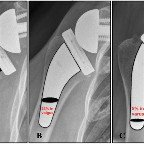 Planned And Postoperative Ccd Angles Of The Optimys Stem In 109